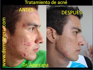 Tratamiento Acne. Lima. Deprime el acne? ~ Tratamiento de acne, manchas ...