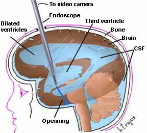 Medical World: Hydrocephalus
