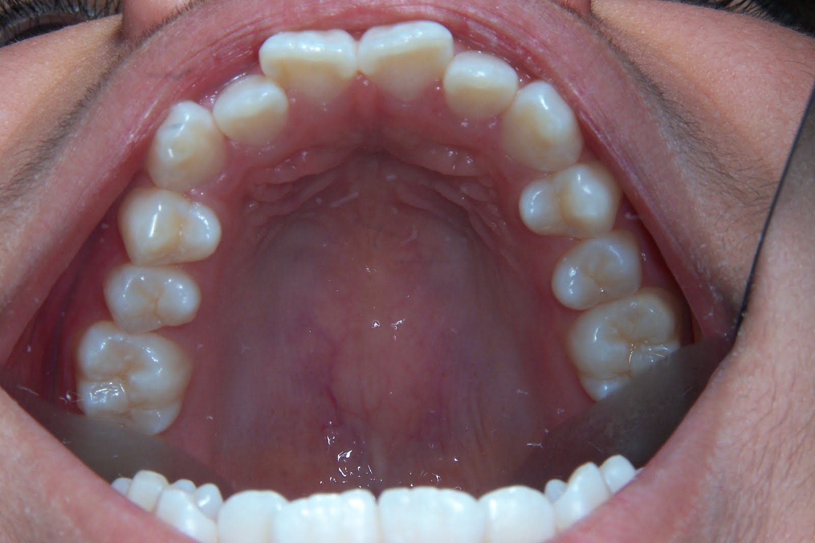 invisaligninfo: Invisalign Before and After Cases