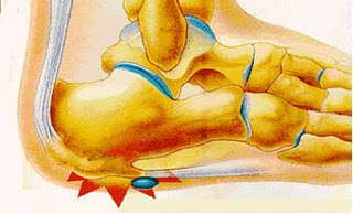 Esporão de Calcâneo - Fascite Plantar