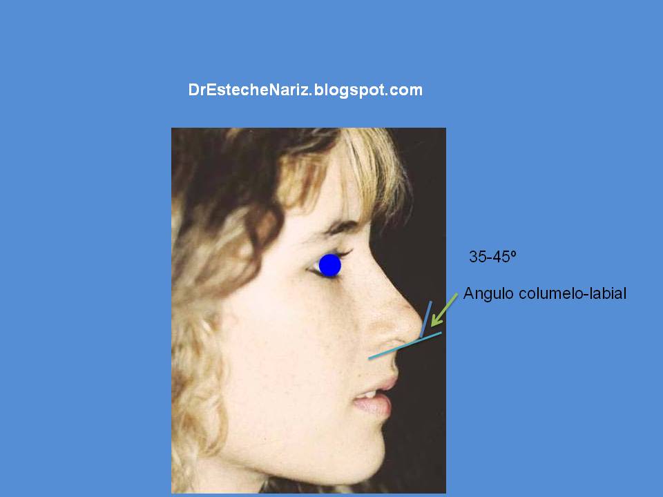 Dr Esteche | Rinoplastia | Cirugía | Plástica de Nariz | Nose |Surgery ...