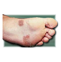 Podóloga Andréa Coelho Lima: DISIDROSE