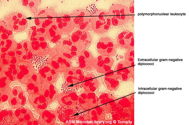 ETS ♀ ♂: Gonorrea o Gonococia