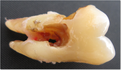 David's Bone Marrow Transplant - Jesus Heals: Day +1214 : Extraction of ...