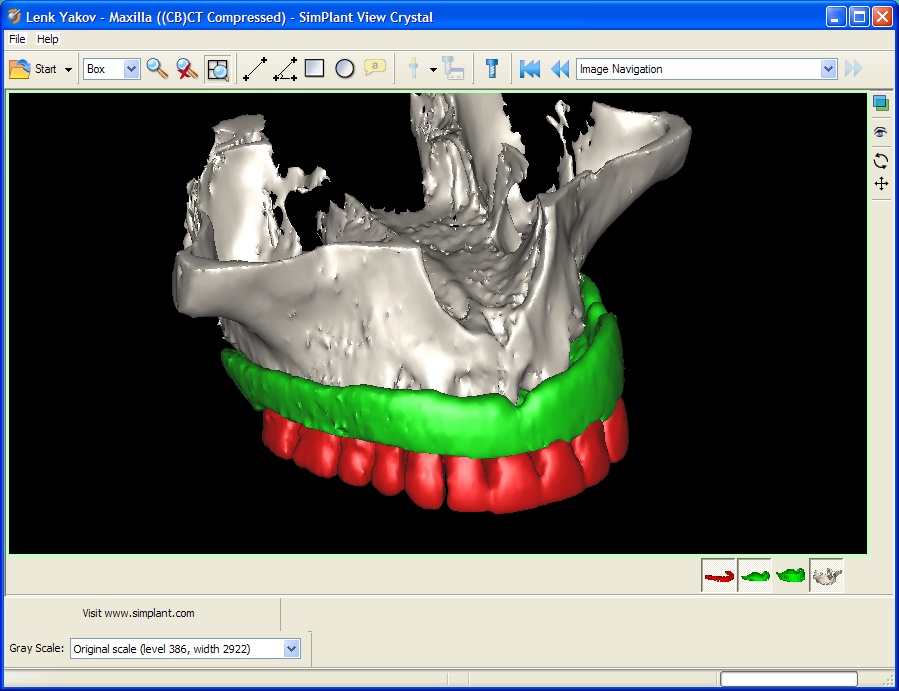 SimPlant Israel: Dual Scan vs. Single Scan