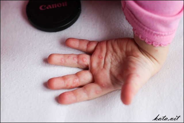 Vítovi: rukou nohou úst