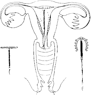 Actitud: Jóvenes Pro-Vida: ¿Es el dispositivo intrauterino (DIU) abortivo?
