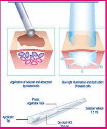 Persian Medical Group: Phototherapy & Photochemotherapy Ward of Razi ...