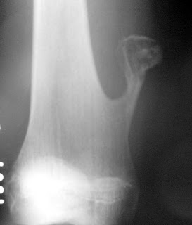 O Radiologista: Osteocondroma