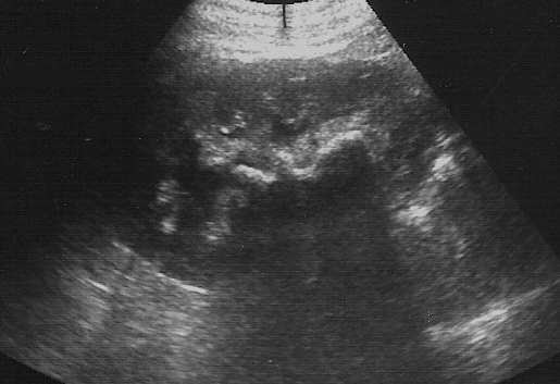 O Radiologista: Cálculo Coraliforme