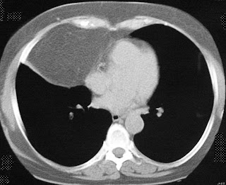 O Radiologista: Hérnia de Morgagni