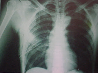 procedimientos medicos en trauma: COLOCACION DE TUBO A TORAX