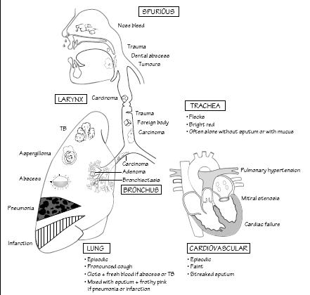 Surgery At a Glance: 3 Haemoptysis