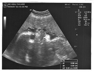 Ultrasound Pictures