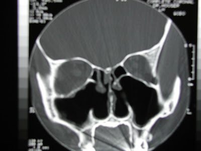 Megan's CT/MRI Pathology: Empty Nose Syndrome