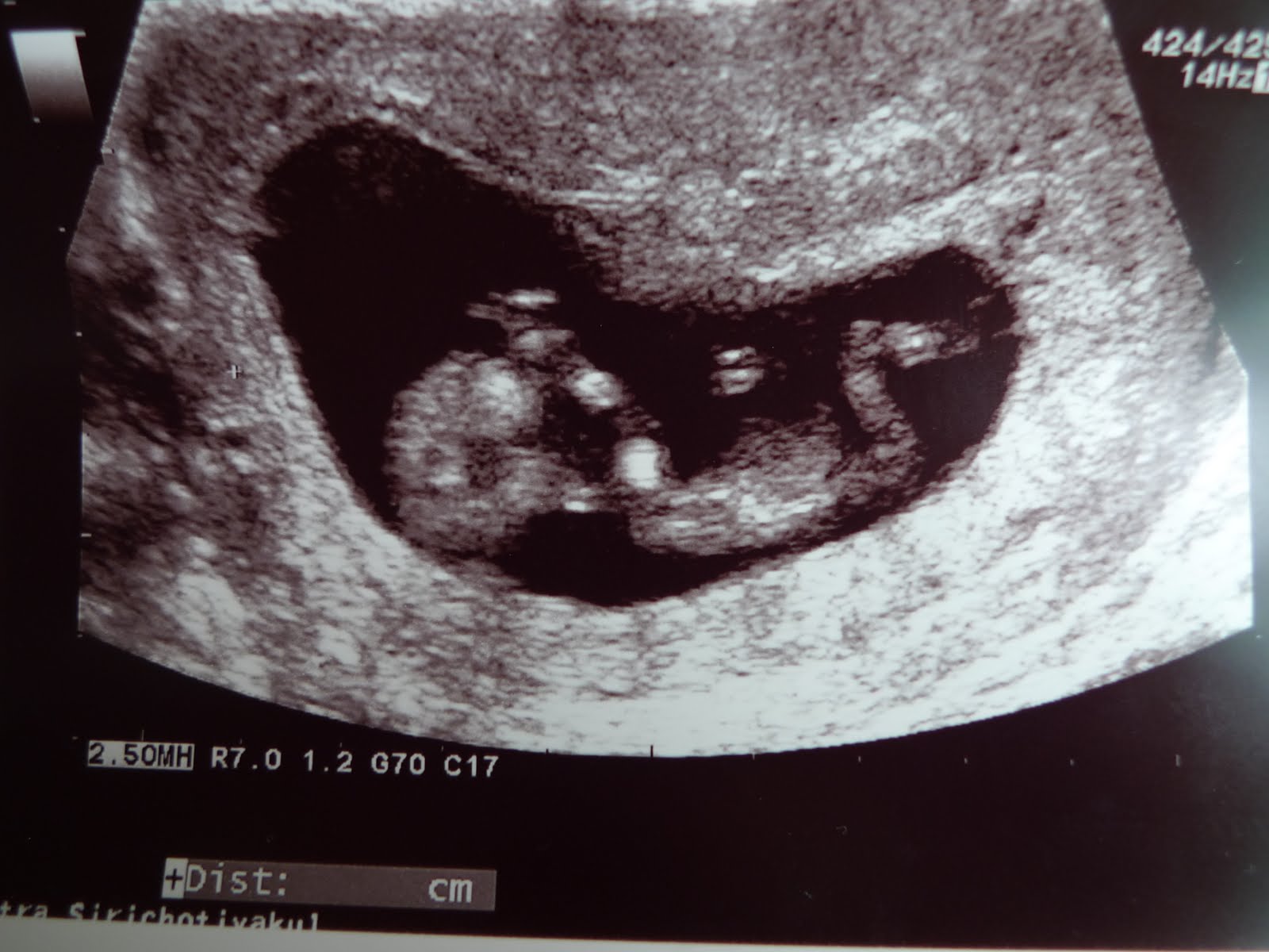 Ultrasonidos De 3 Meses De Embarazo Imagui