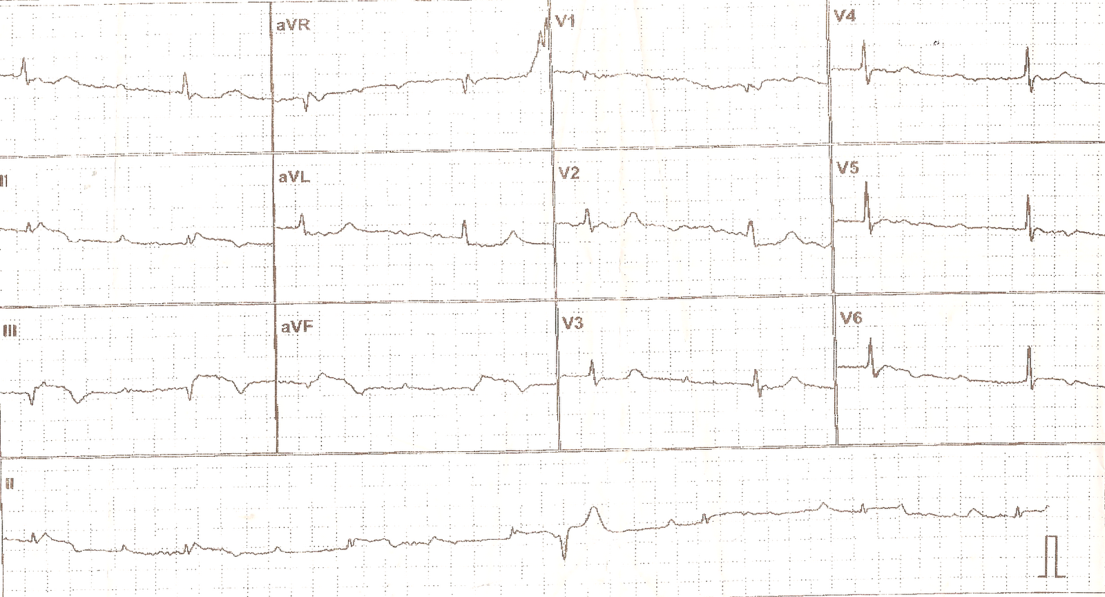 Blog de Eletrocardiografia: Outubro 2010