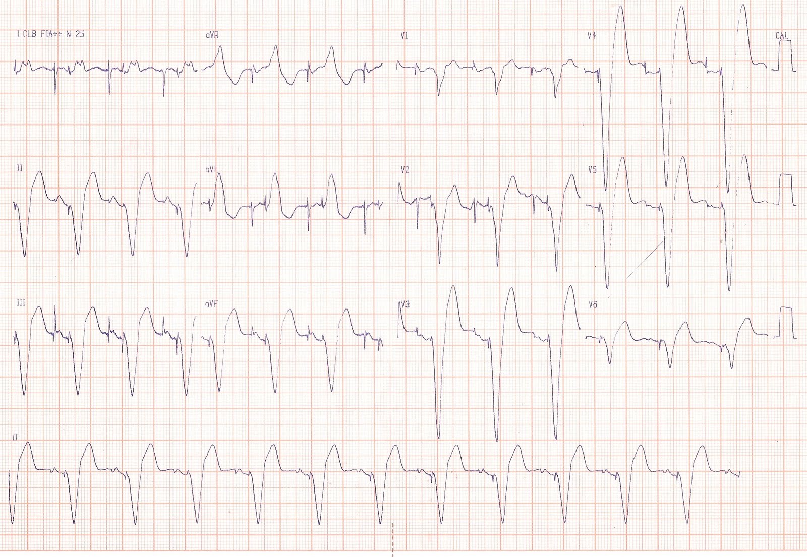 Blog de Eletrocardiografia: ECG COM DISCUSSÃO: MARCAPASSO CONVENCIONAL ...