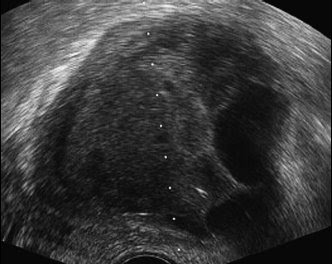 TUBOOVARYAN ABSE (TOA)