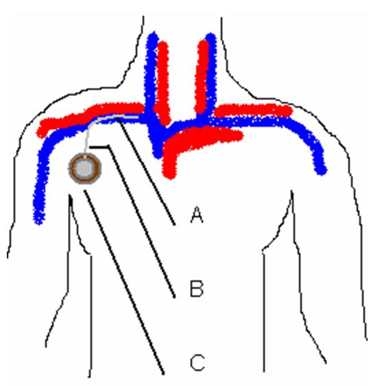Hemo-Blog: Cateter implantável