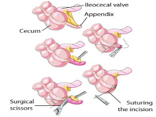 AO-MEDICINE: Appendicectomy : Types, Indications, Steps, Postoperative ...