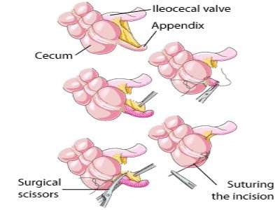 AO-MEDICINE: Appendicectomy : Types, Indications, Steps, Postoperative ...