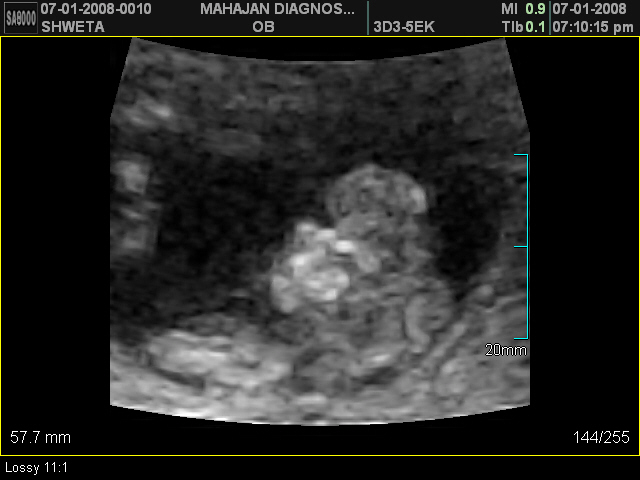 DR.ARUN MAHAJAN: ACRANIA