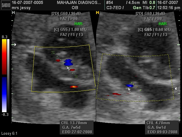 DR.ARUN MAHAJAN: DISCORDANT TWINS
