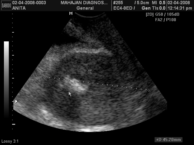 DR.ARUN MAHAJAN: ENDOMETRIAL CALCIFICATION