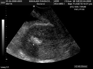 DR.ARUN MAHAJAN: ENDOMETRIAL CALCIFICATION