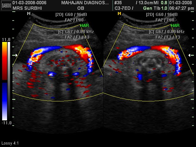 DR.ARUN MAHAJAN: 1,2,3, CORD LOOPS