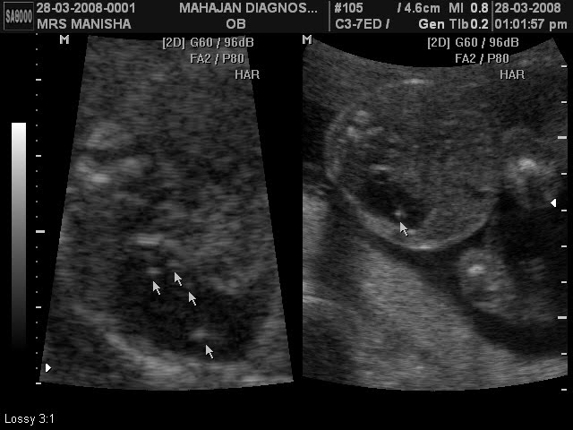 DR.ARUN MAHAJAN: ECHOGENIC FOCUS IN STOMACH