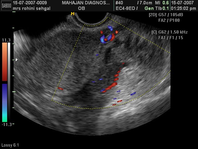 DR.ARUN MAHAJAN: RUPTURED ECTOPIC