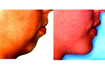 Cirugia Ortognatica y Maxilofacial