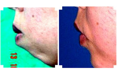 Cirugia Ortognatica y Maxilofacial: BIPROTRUSION MAXILAR