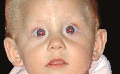 Exámenes Oftalmológicos: Test de Hirschberg