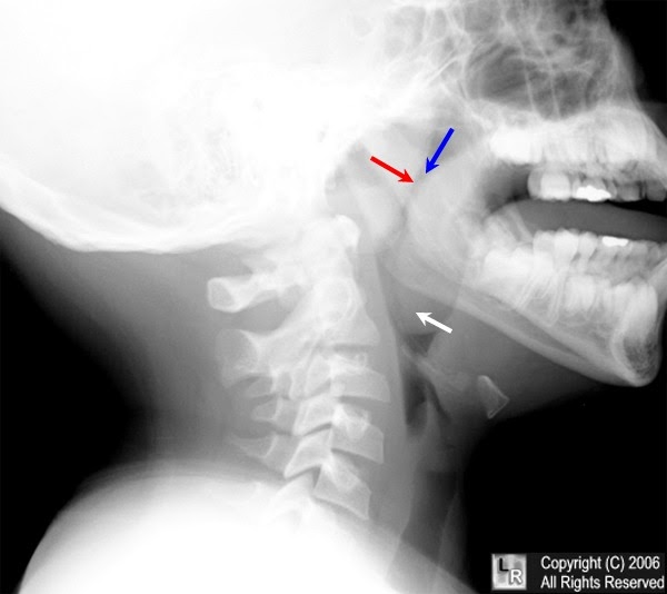 ENT Surgeon's blog: Adenoids