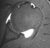 CT Pathology Blog: Labral Tear of the Shoulder