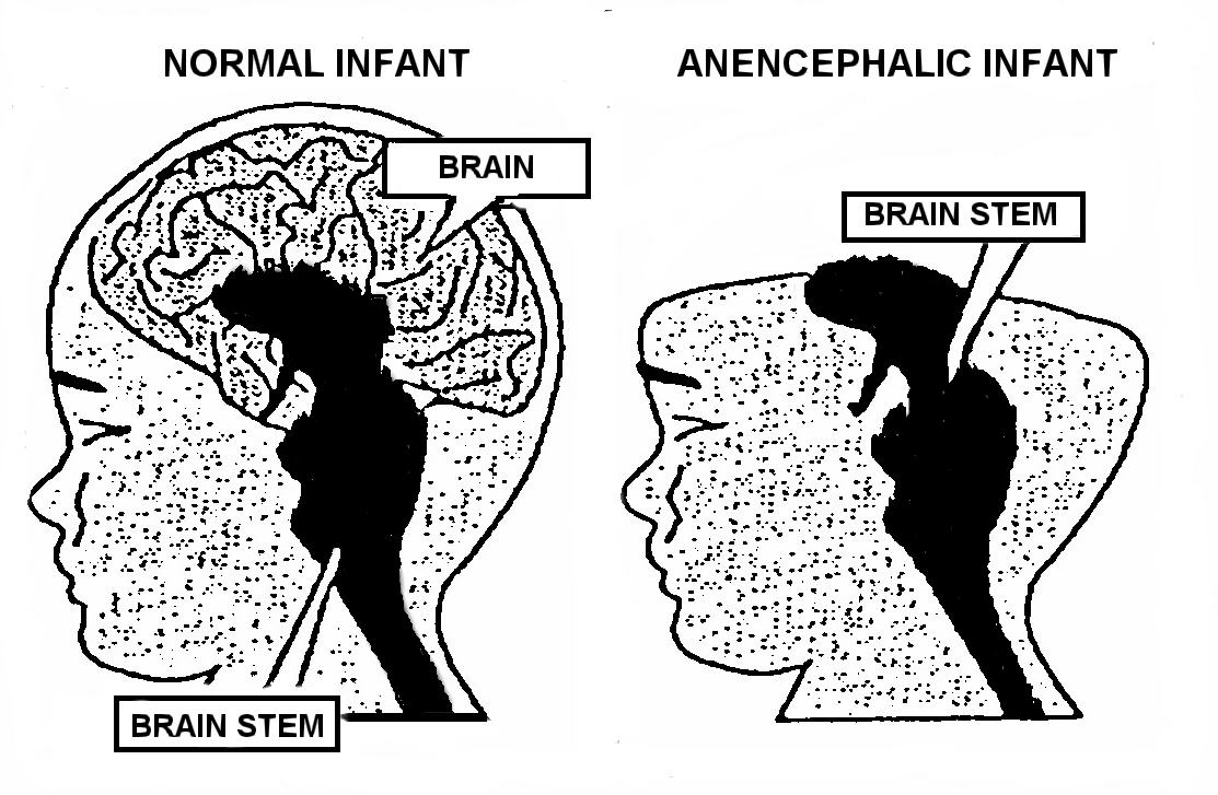 Elspeth Allyson: What is anencephaly?