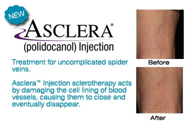 Beverly Hills Plastic Surgery Group: Asclera: The Newest FDA Approroved ...