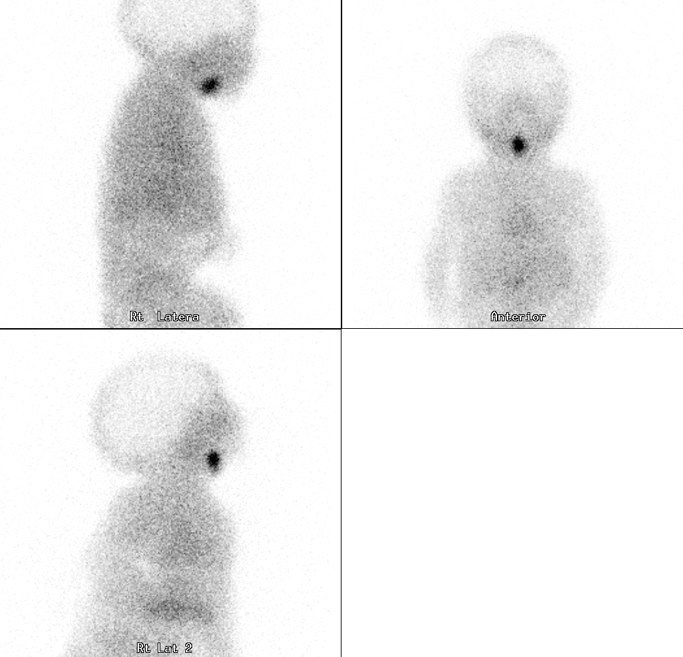 Nuclear Medicine & PET: Thyroid scintigraphy: Paediatric