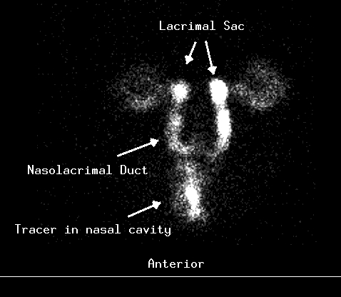 Nuclear Medicine & PET: Lacrimal Scintigraphy