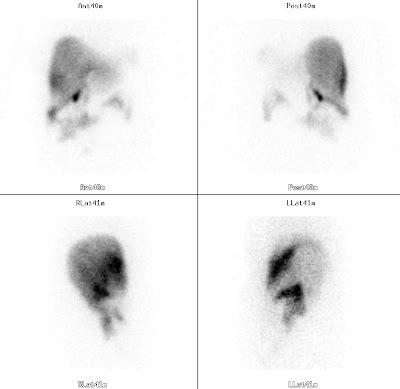 Nuclear Medicine & PET: HIDA study