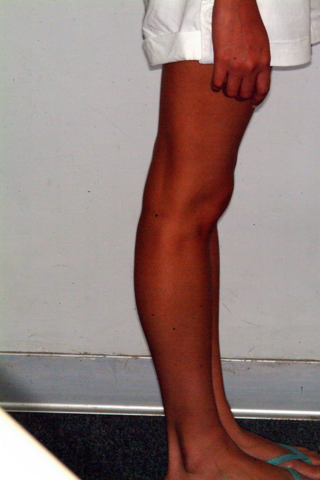 Ortodoncia y ATM: Hiperlaxitud Ligamentosa