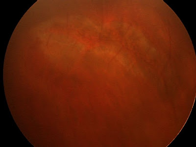 Pediatric Retina: Stickler Syndrome-Part 3 (Photographic Collection)