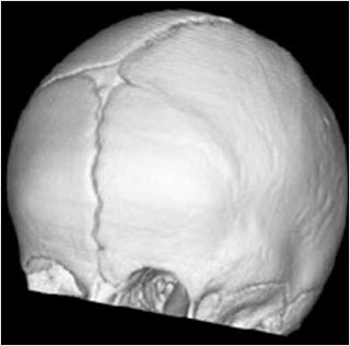 Craneosinostosis: Craneosinostosis