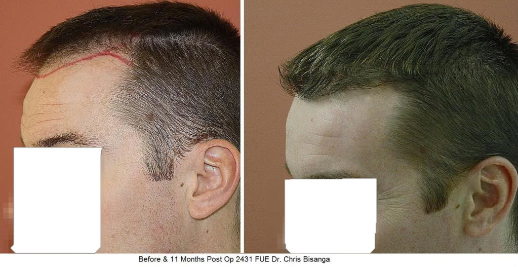 Greffe de cheveux: Tous les éléments à connaître quand on l'envisage ...