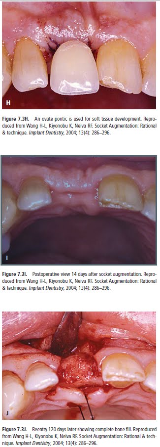 Socket Augmentation: Rationale and Technique (Part 2) | Perio and ...