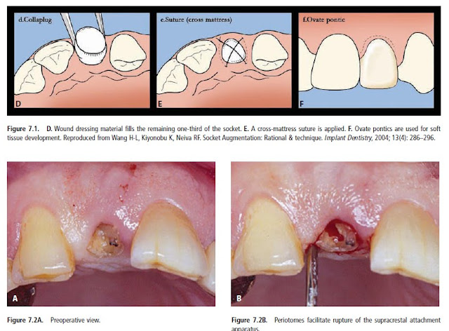 Socket Augmentation: Rationale and Technique | Perio and Implant ...