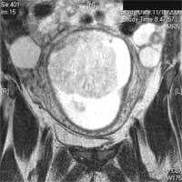 Kathy's MRI Pathology Blog: Molar Pregnancy / Pelvic and Reproductive ...